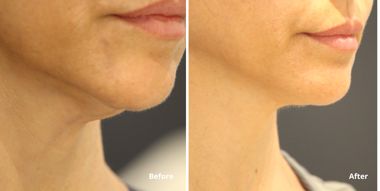 Neck Thread Lift - Face and Eye Aesthetics