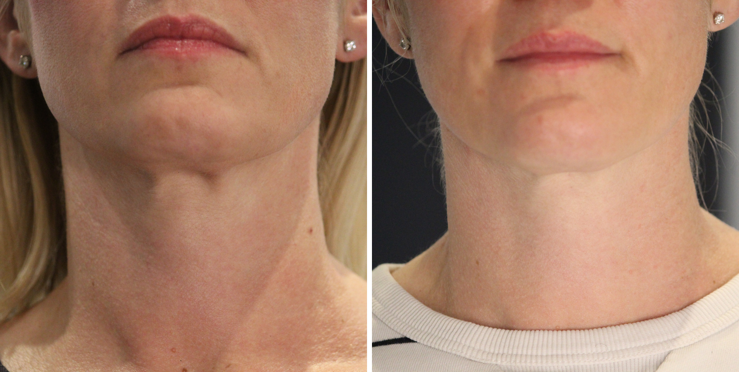 Neck Thread Lift - Face and Eye Aesthetics