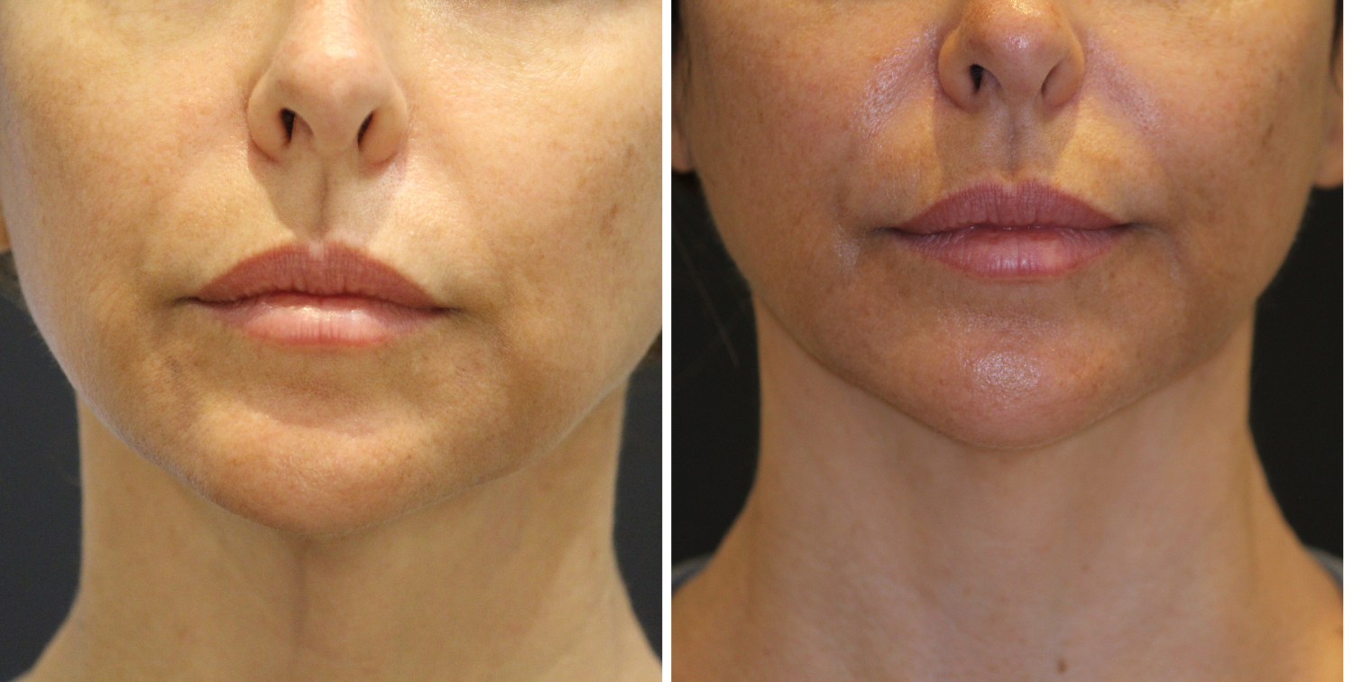 Neck Thread Lift - Face and Eye Aesthetics