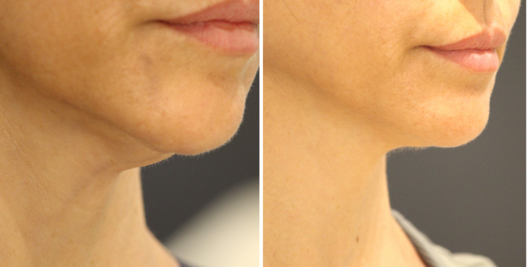 Neck Thread Lift Sydney | Non-Surgical Neck Rejuvenation by Dr ...
