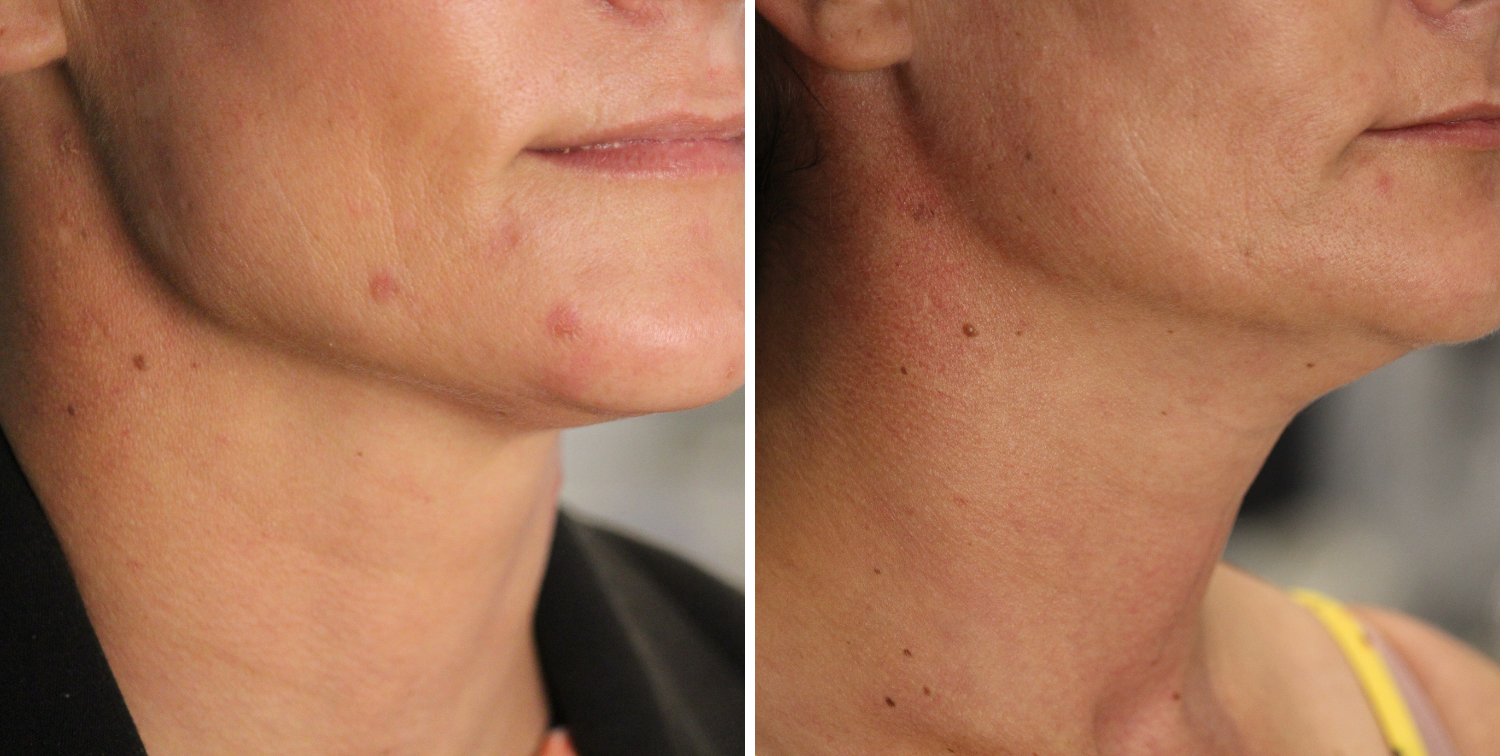 Neck Thread Lift - Face and Eye Aesthetics