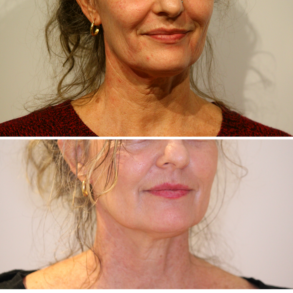 Neck Thread Lift - Face and Eye Aesthetics