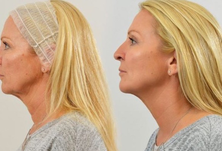 Neck Thread Lift - Face and Eye Aesthetics
