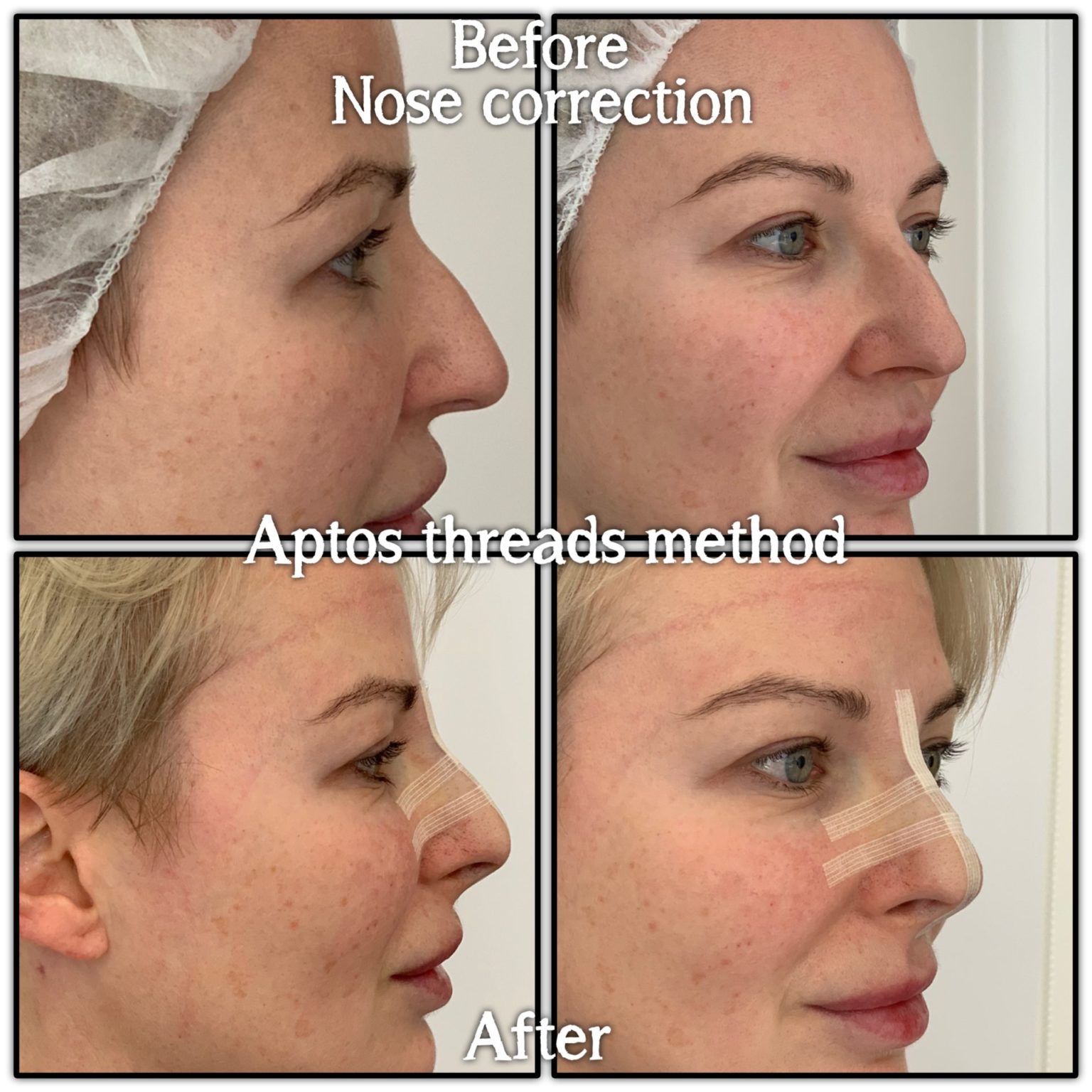 Looking for a Nose Thread lift in Sydney?