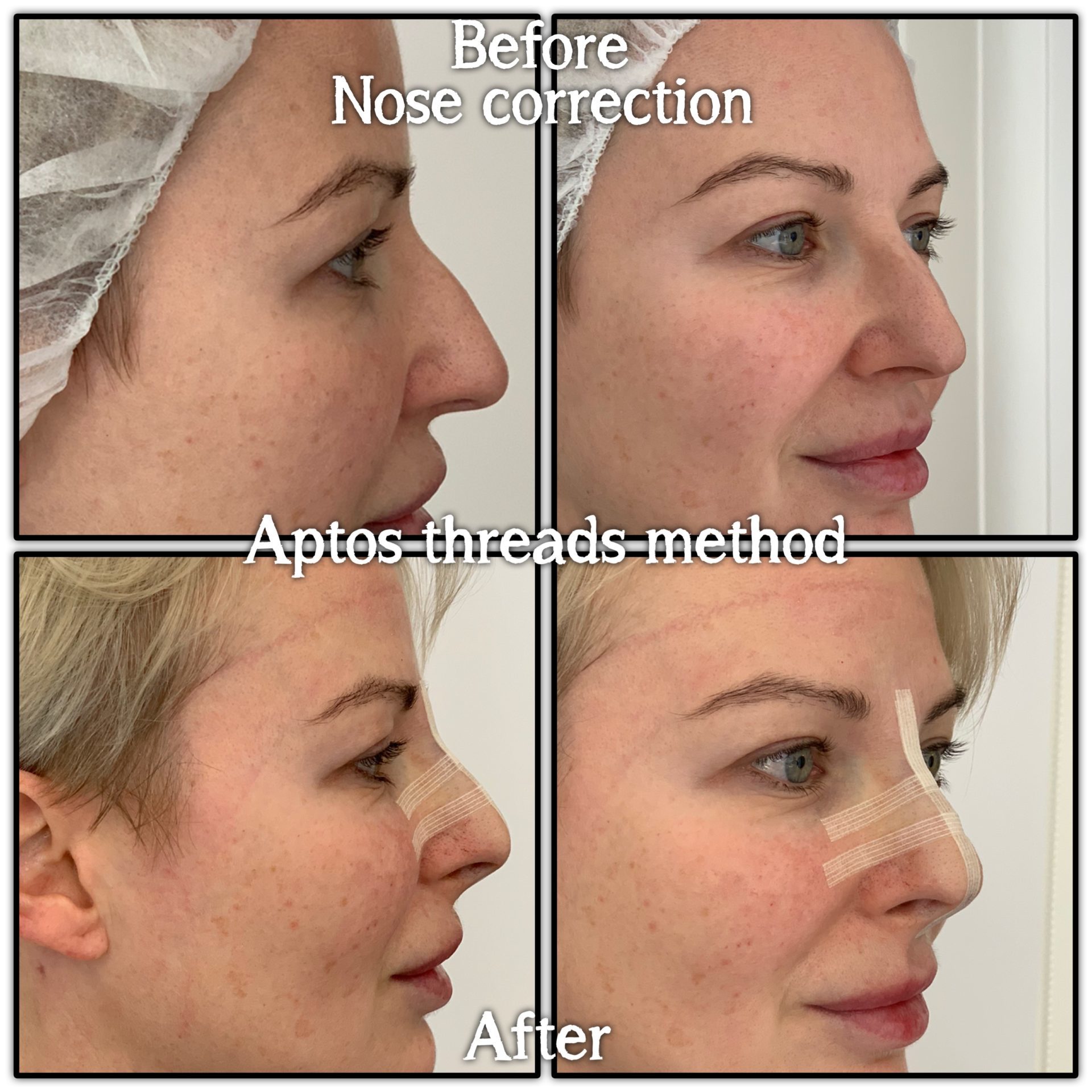 Looking for a Nose Thread lift in Sydney?