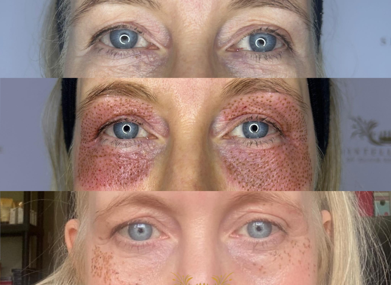 Plasma Pen Treatment - Face and Eye Aesthetics